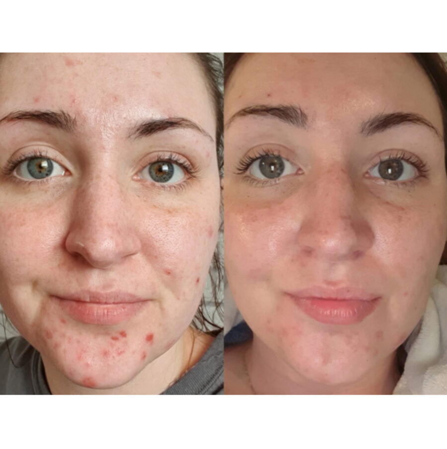 Five Effective Ways to Treat and Prevent Hyperpigmentation - Dr Beauty